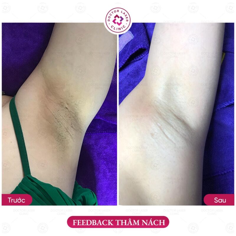 Trị thâm nách - Doctor Laser