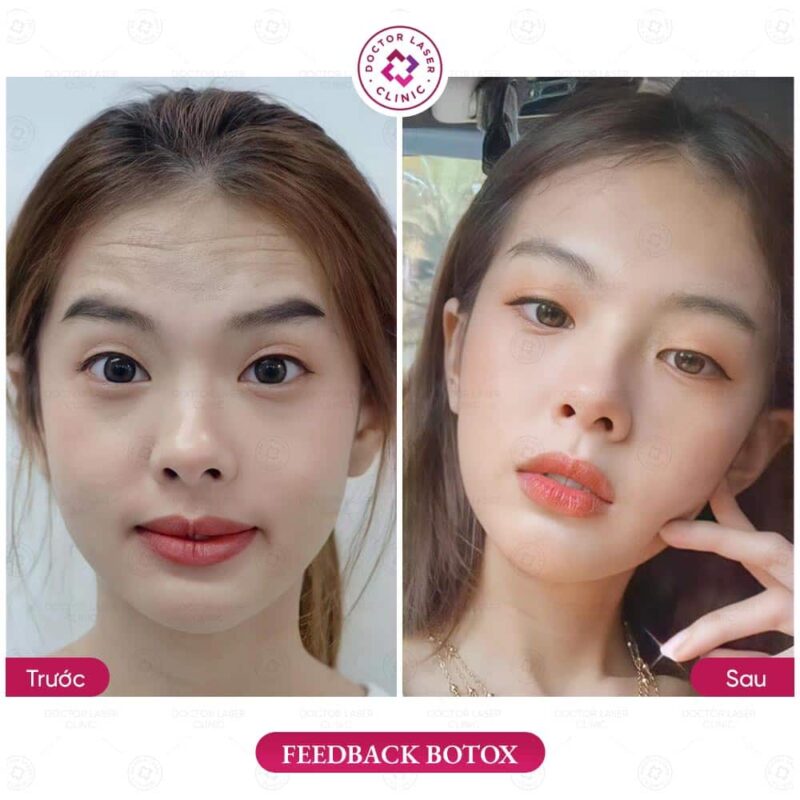 Tiêm Botox - Doctor Laser