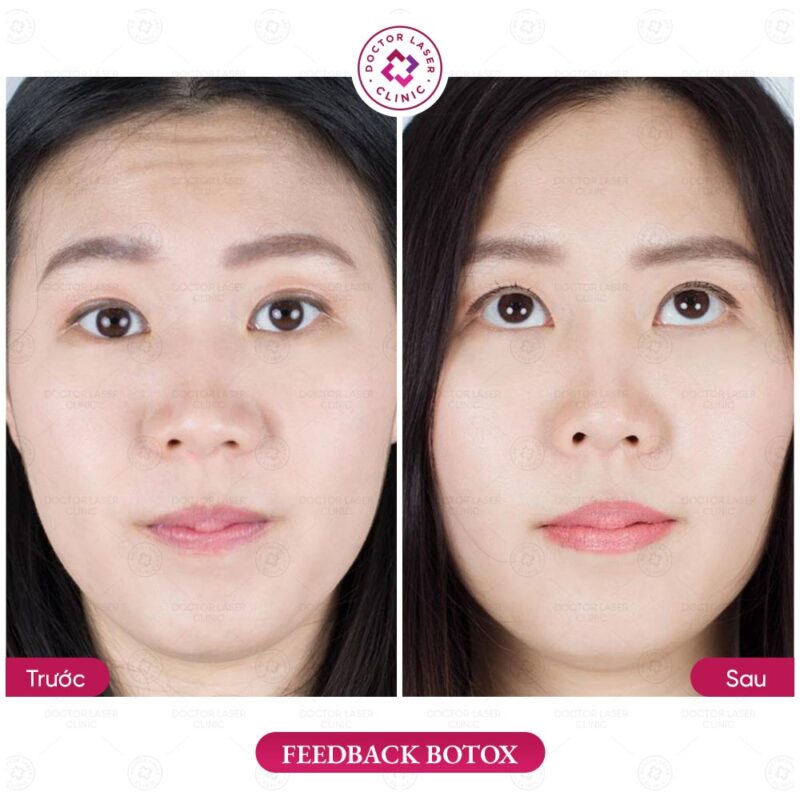 Tiêm Botox - Doctor Laser