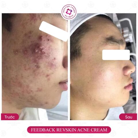 Kem Trị Mụn Viêm RevSkin Acne Cream 10g - Phòng khám Da liễu Thẩm mỹ ...